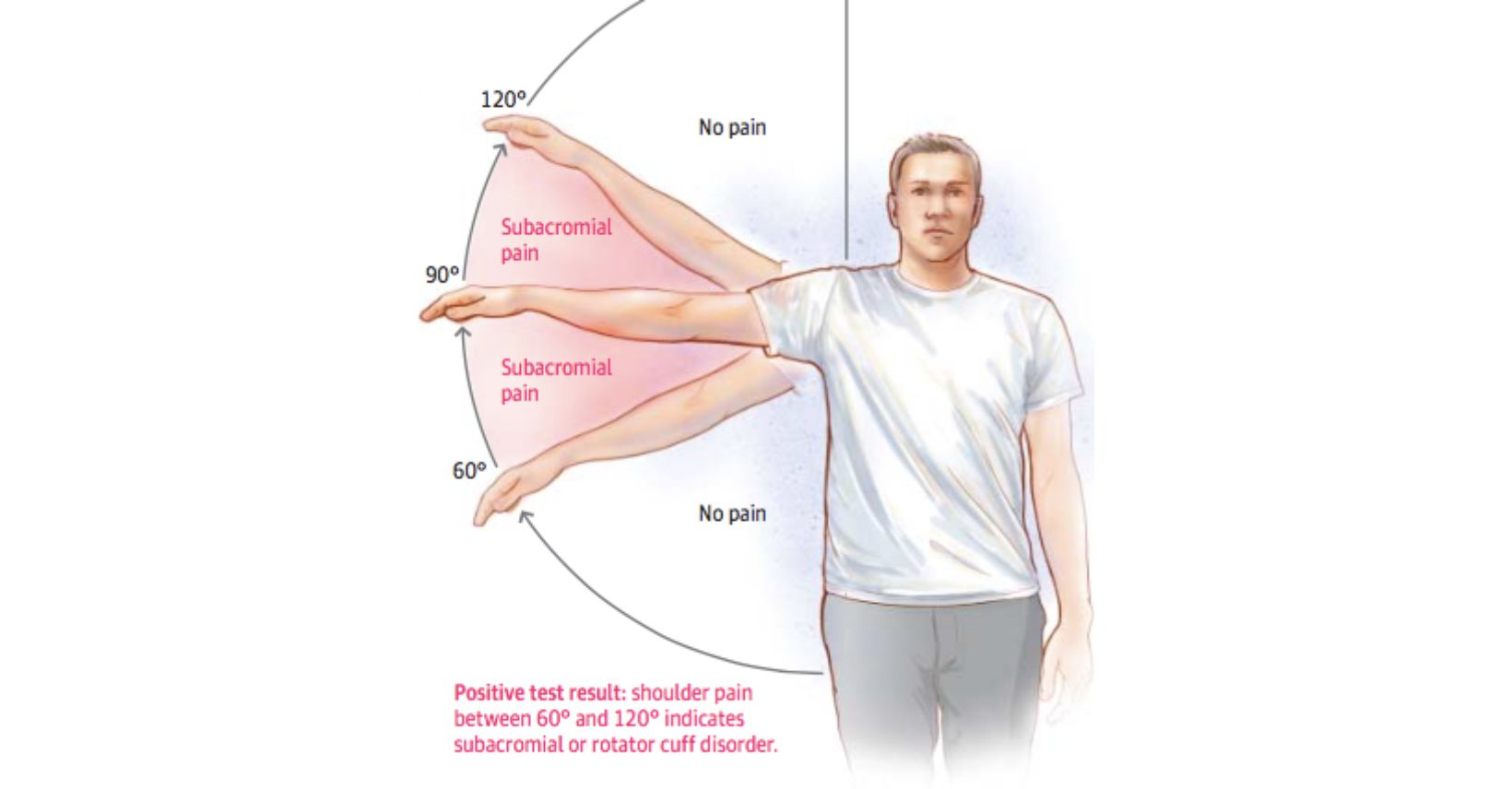 Kecederaan Bahu (Shoulder Impingement): Gejala, Rawatan, dan Protokol ...