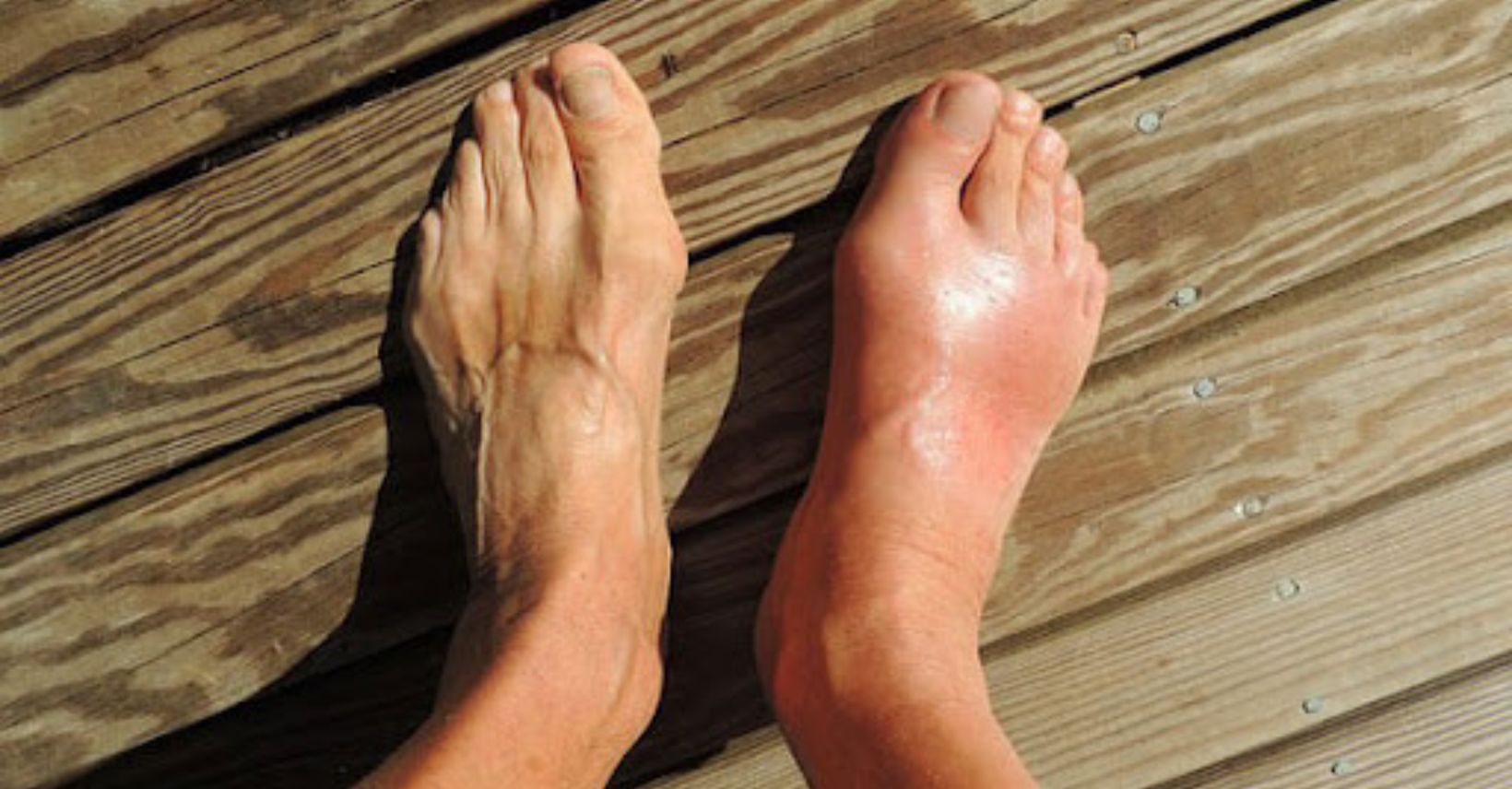 Gout di Usia Muda: Adakah Diet Tinggi Protein Menjadi Punca?